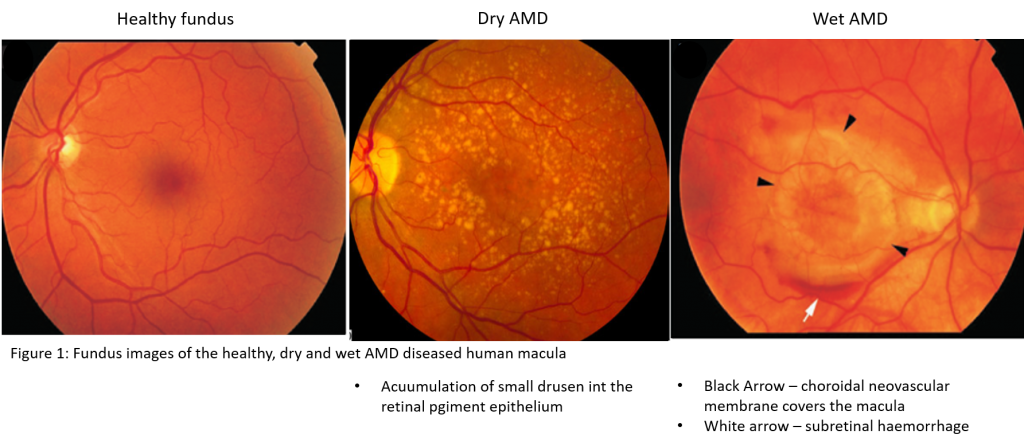 Predictive biomarkers and new therapeutic targets for Age-related ...